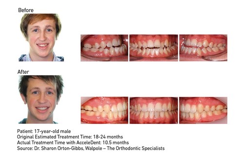 Journal of Clinical Orthodontics Publishes Case Study Highlighting ...
