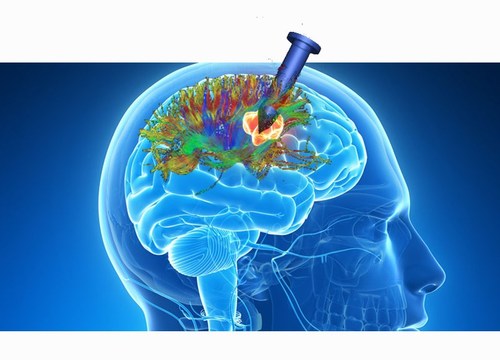 NICO Announces First Patient Enrolled in Phase 3 Randomized Controlled ...