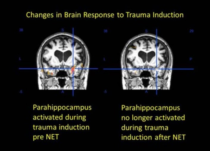 PTSD Can Be Treated at a Fraction of the Cost Using NET Mind-body Technique