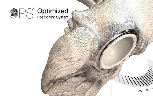 Corin Group Launches Optimized Positioning System (OPS™) for Hip ...