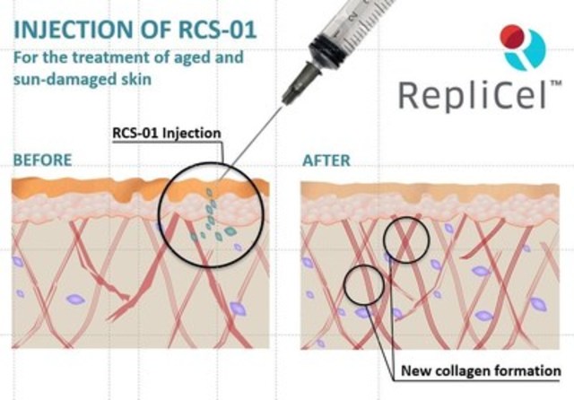 Positive Results from RepliCel's RCS-01 Phase I Skin Trial are the ...