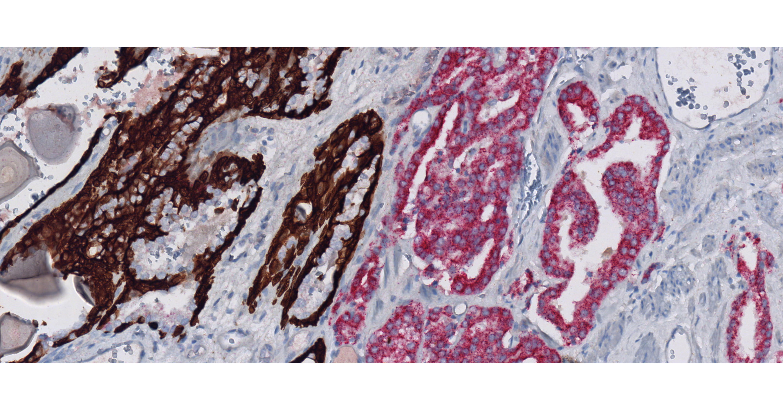 Roche launches antibody test to aid in diagnosis of challenging ...