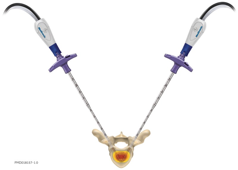 Medtronic Expands Pain Therapies Portfolio with the Launch of OsteoCool ...