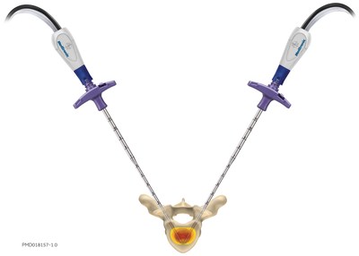 Medtronic Expands Pain Therapies Portfolio with the Launch of OsteoCool ...