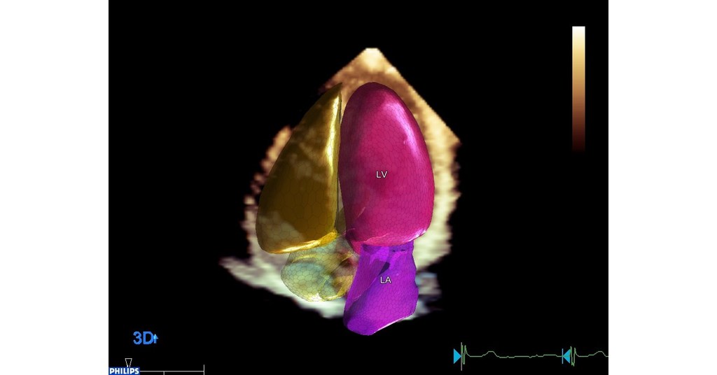 Multicenter study demonstrates 3D Echo image analysis with Philips ...