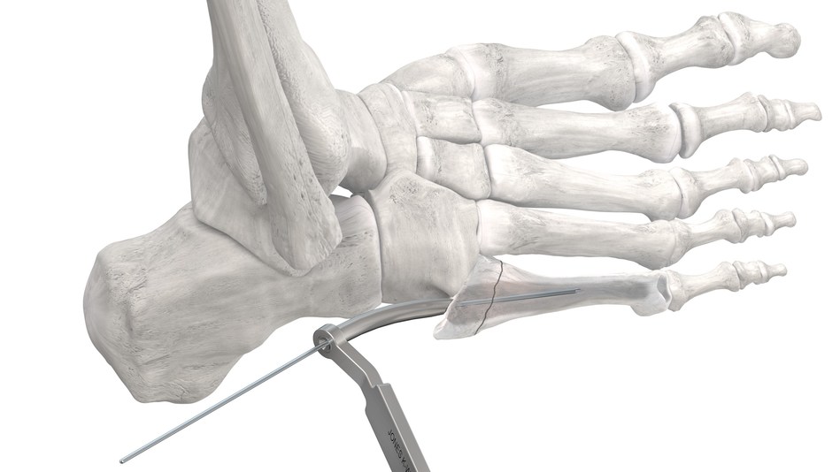 Paragon 28® launches the industry's most robust screw and ...