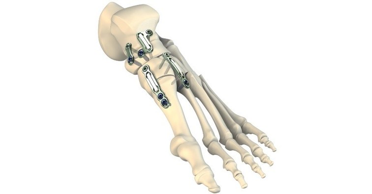 CrossRoads® Extremity Systems, LLC Announces Launch of the DynaFORCE ...