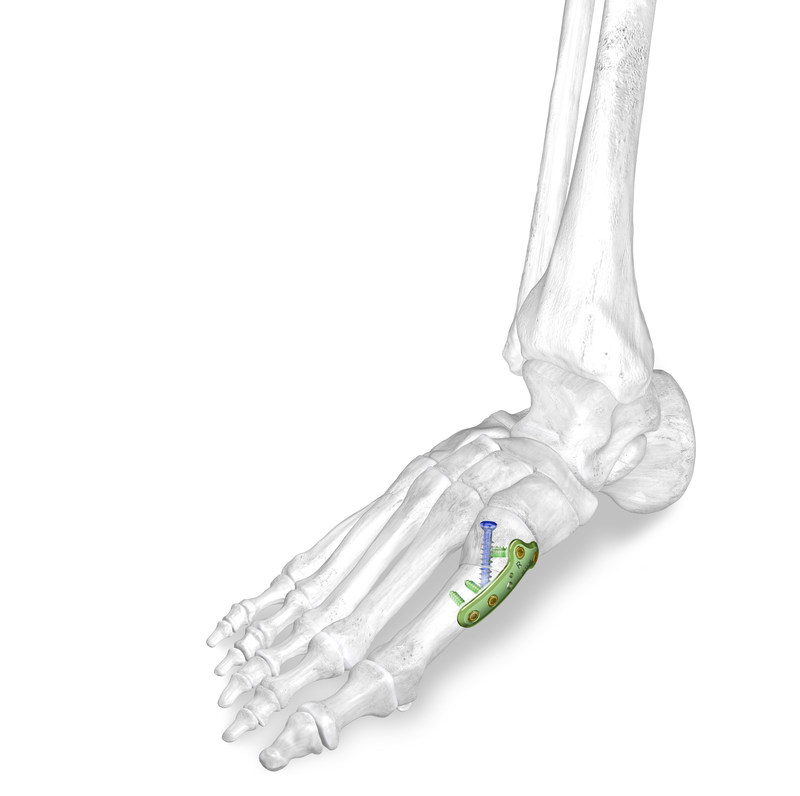 Paragon 28® expands innovative product portfolio with the launch of the ...