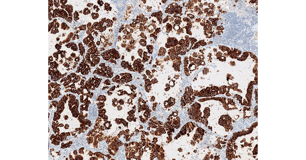 Roche gains CE label expansion for companion diagnostic to identify ALK ...