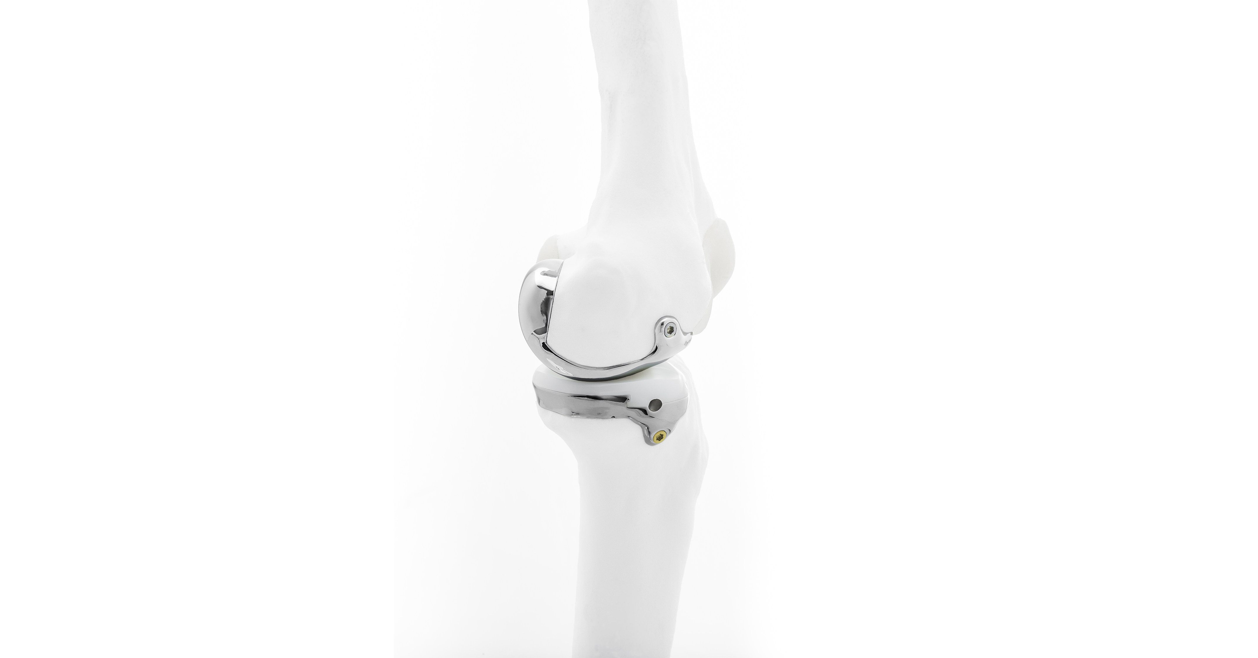 Bodycad Announces First Use of Its Unicompartmental Knee System in Patients