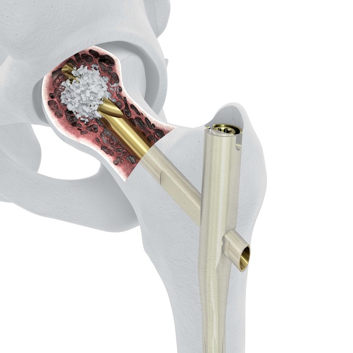 DePuy Synthes Spine Introduces EXPEDIUM VERSE® Spinal System