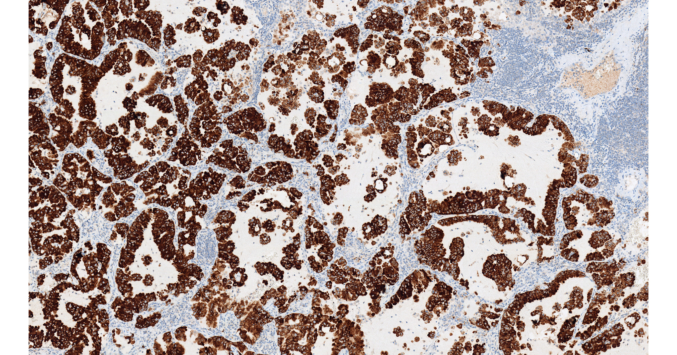 Roche receives FDA approval for VENTANA ALK (D5F3) CDx Assay to ...