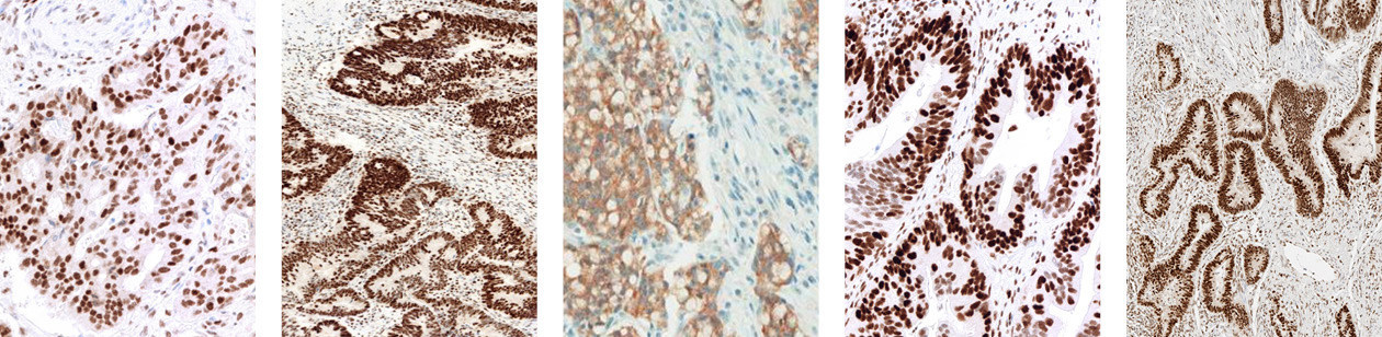 Roche receives FDA clearance for the VENTANA MMR IHC Panel for patients ...