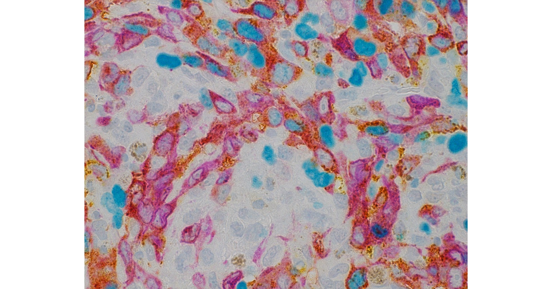 Roche launches DISCOVERY Teal HRP chromogen detection kit to advance ...