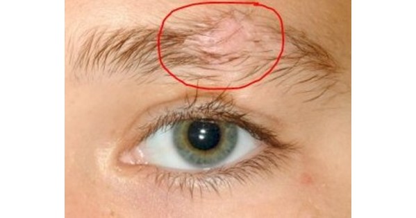 New Drug Plumps Thinning Eyebrows