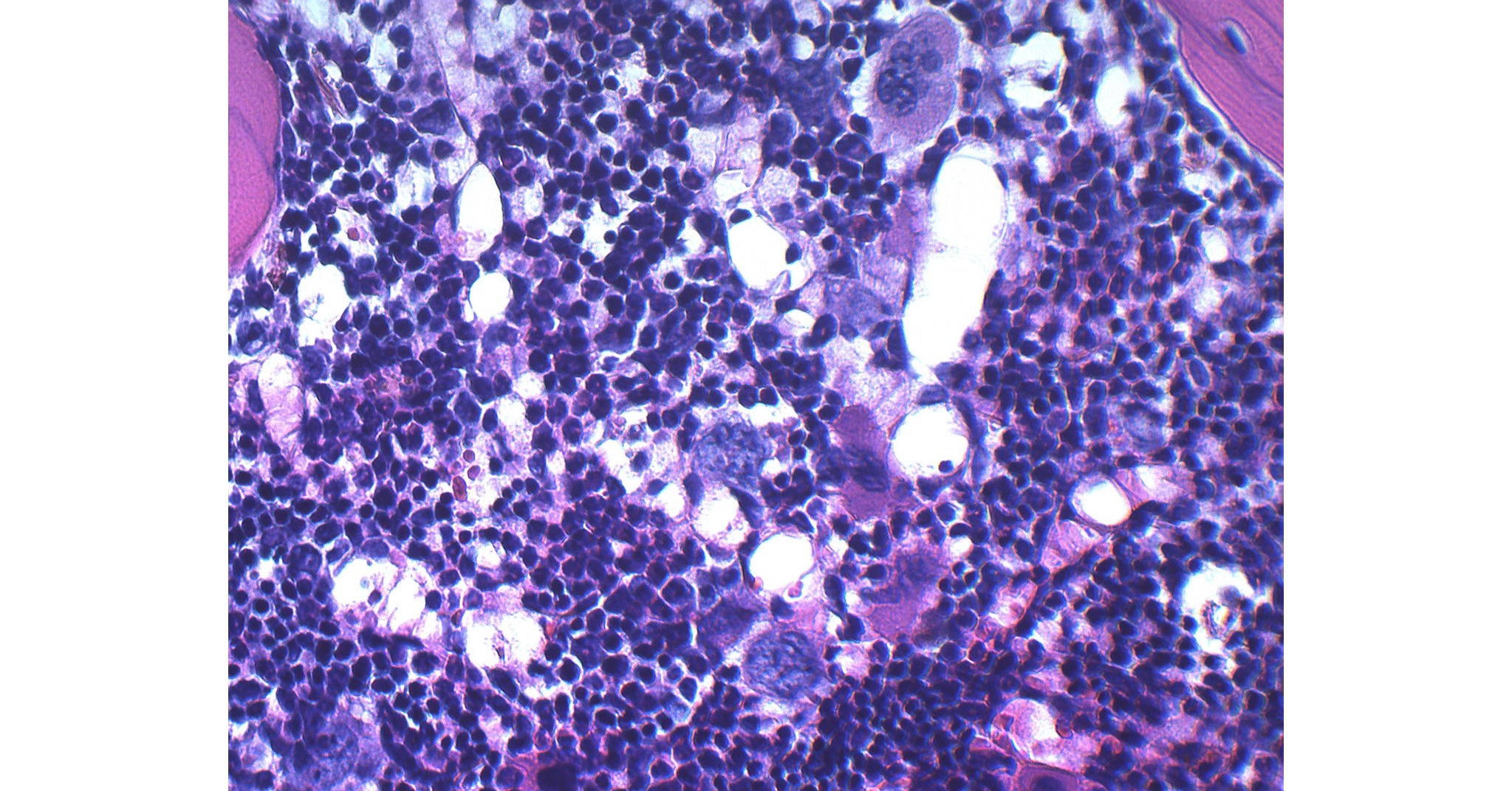 Study Explores Impact of Obesity on Bone Marrow Cells