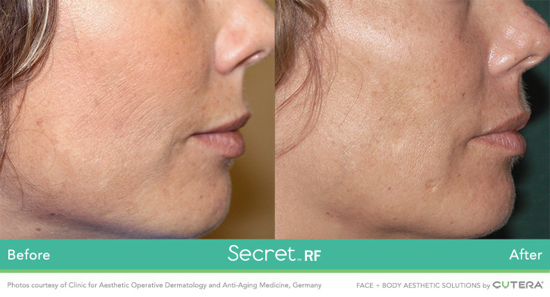 Cutera Enters Two New Aesthetic Markets With Launch Of New Products