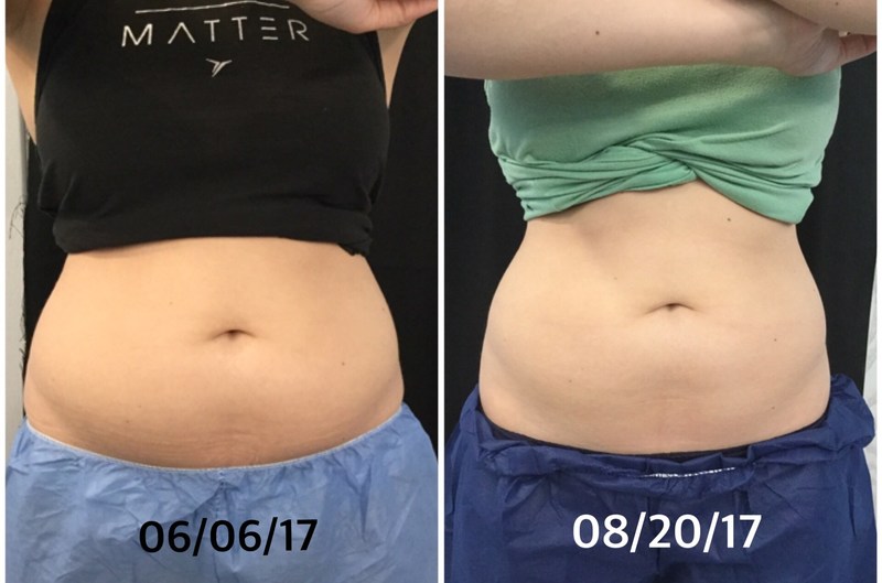 CoolSculpting Procedure Provides Fast Fat Reduction Service via New ...