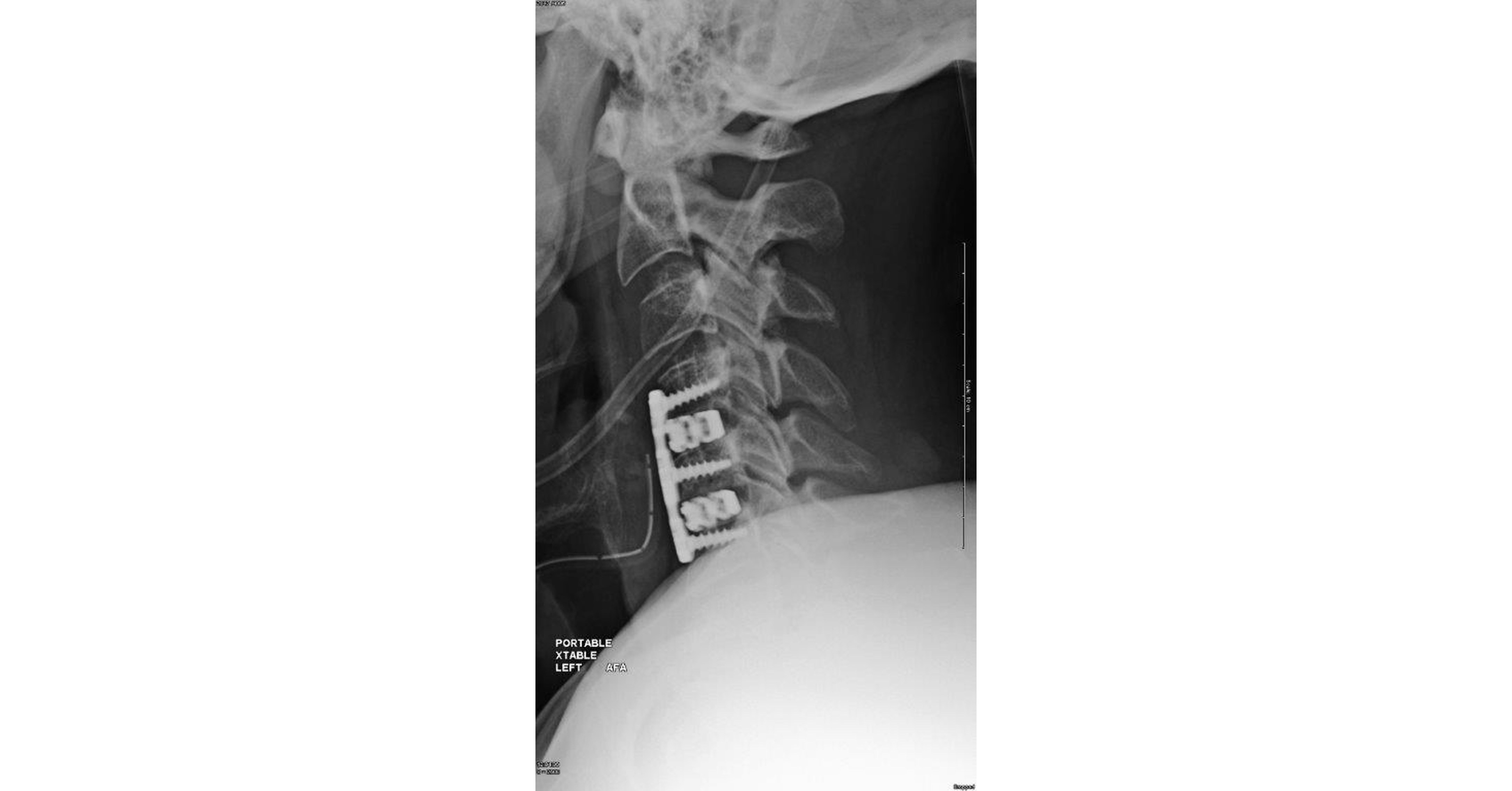 Camber Spine Technologies Announces First Implantations Of SPIRA™-C ...