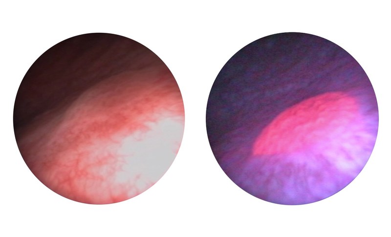 Photocure Announces U.S. FDA Approval of New Indication for Blue Light ...