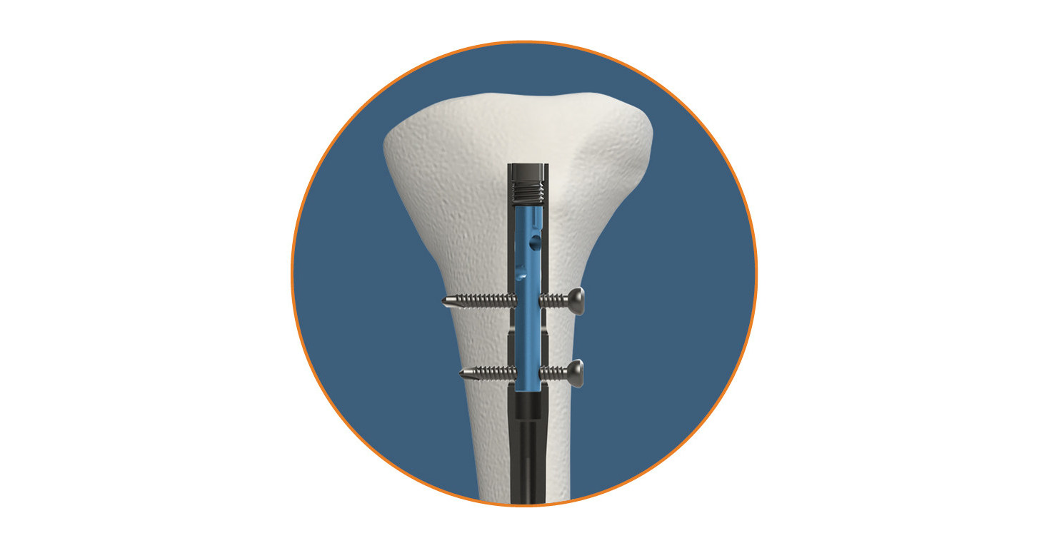 OrthoXel Announces World's First Patient Surgical Implantation of the ...