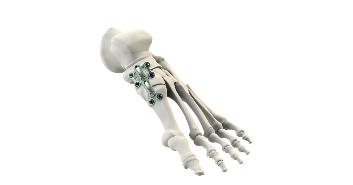 CrossRoads® Extremity Systems Announces Launch of the DynaFORCE® Active ...