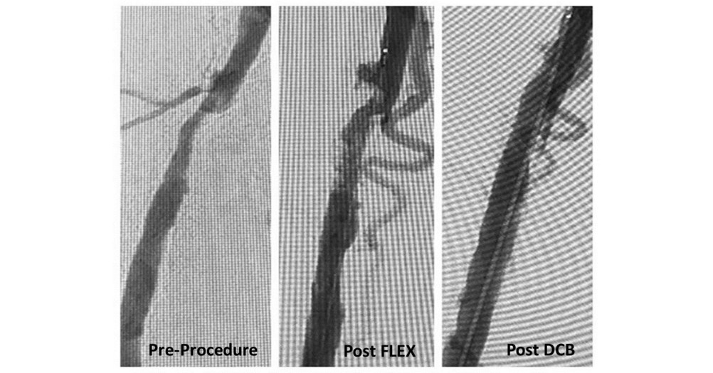 VentureMed Group's FLEX Scoring Catheter® was Featured in a Successful ...