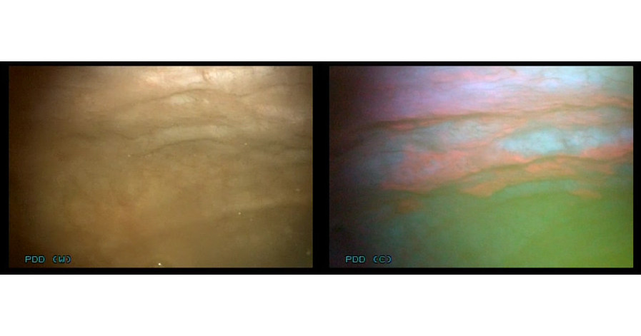 Blue Light Cystoscopy Canada | Shelly Lighting