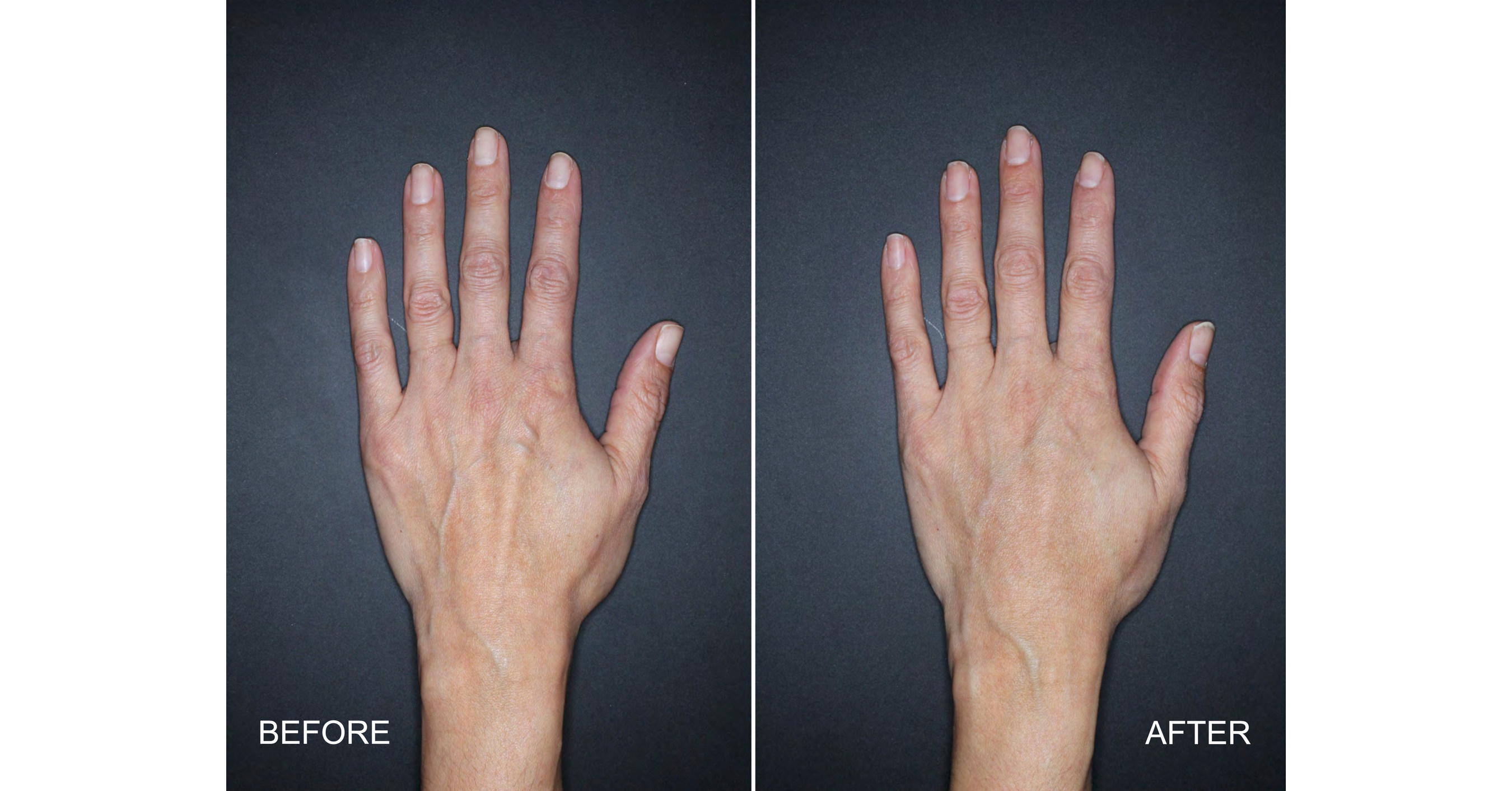 Nestlé Skin Health Announces the FDA Approval of Restylane® Lyft for ...
