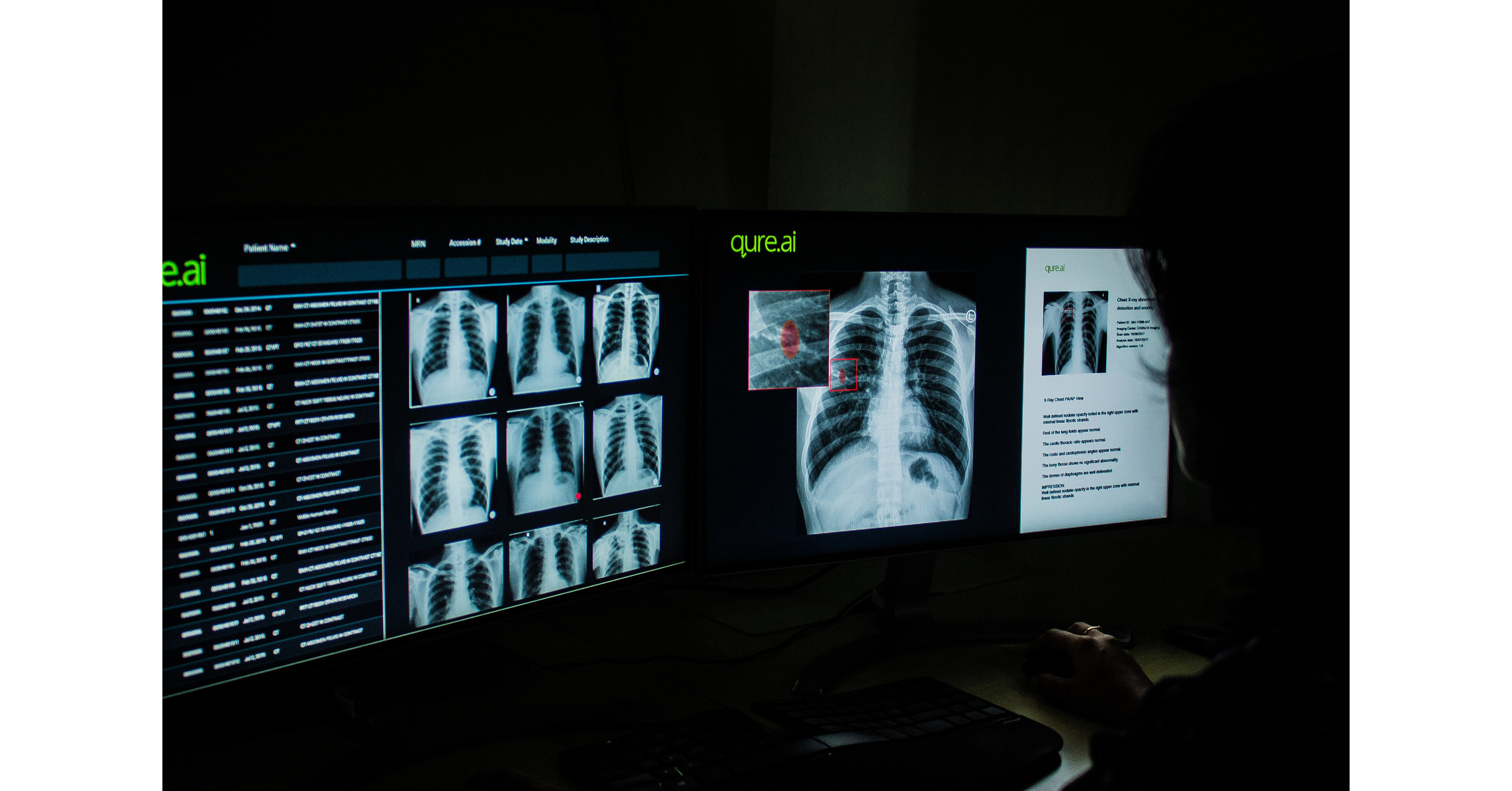 Qure.ai Partners With Teleradiology Solutions (TRS) and Telerad Tech to ...