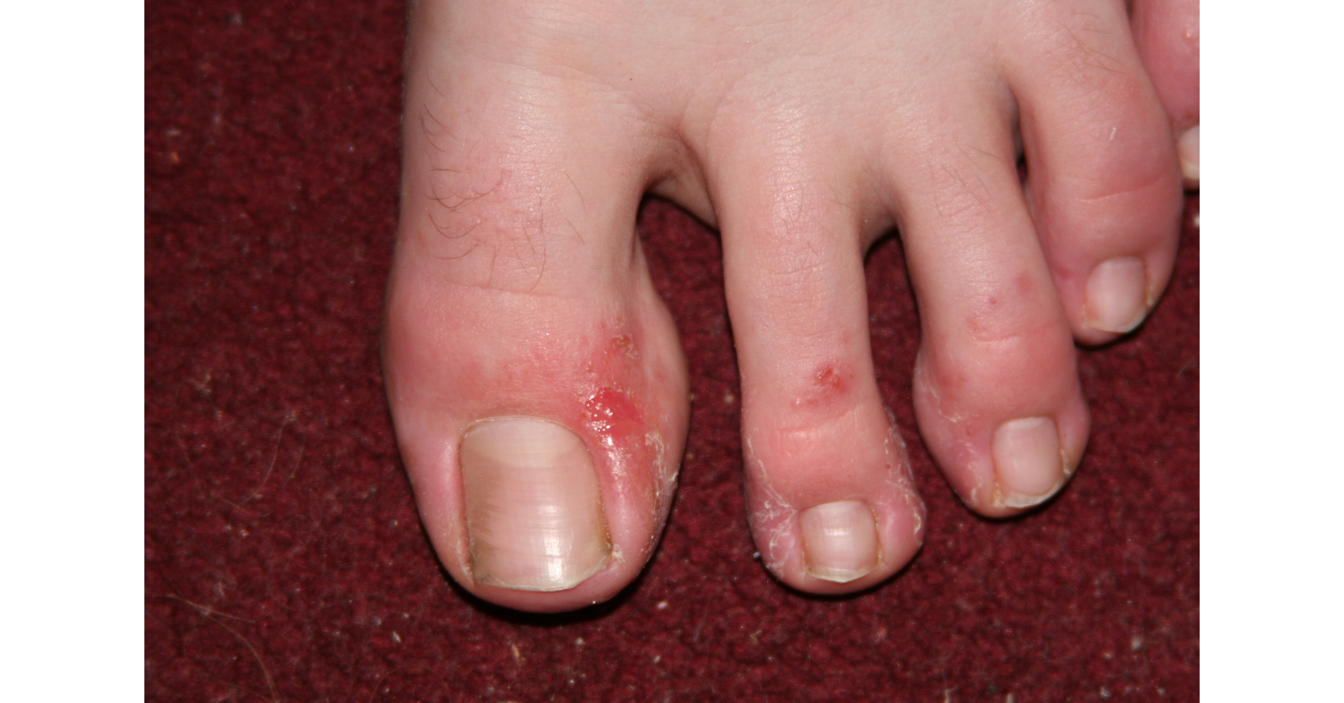 Itch, Scratch, Rash: Allergic Contact Dermatitis, The Lesser Known Allergy