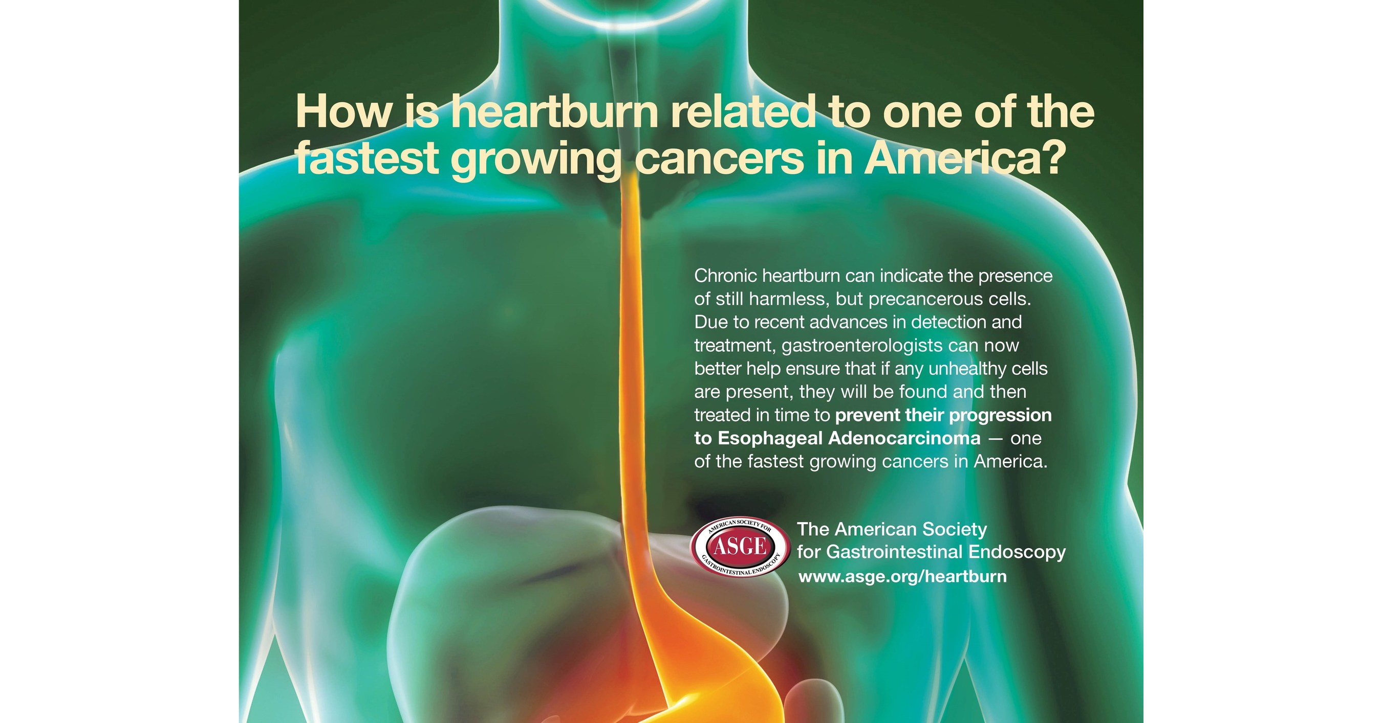ASGE Launches Public Service Awareness Campaign to Preempt Esophageal ...