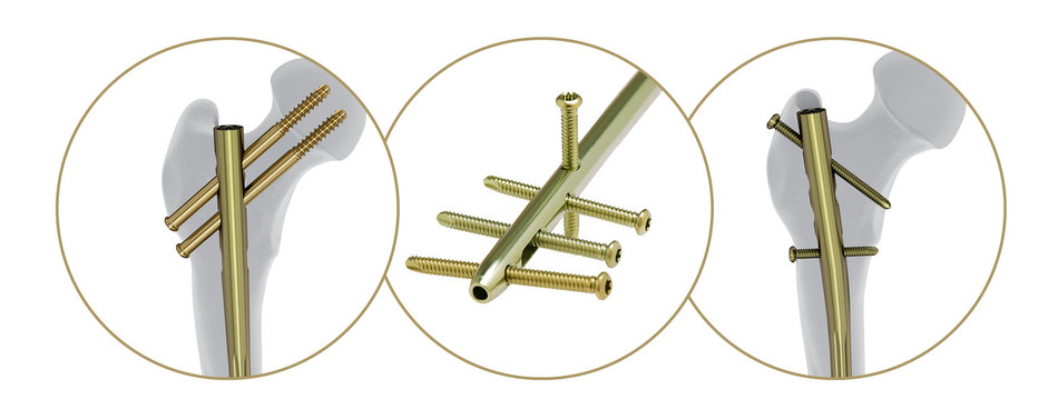 DePuy Synthes Launches Innovative Nailing System Aimed at Improving ...