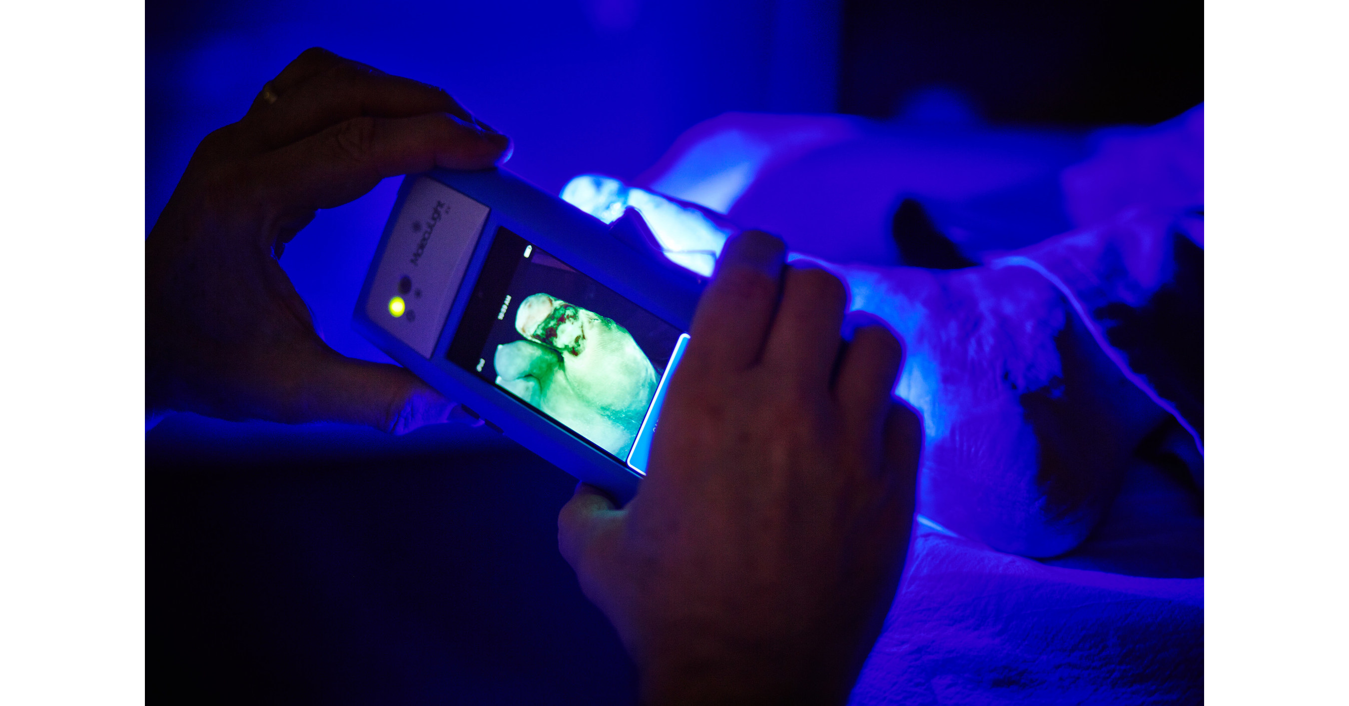 MolecuLight® Inc.'s first-of-its-kind handheld fluorescence imaging ...