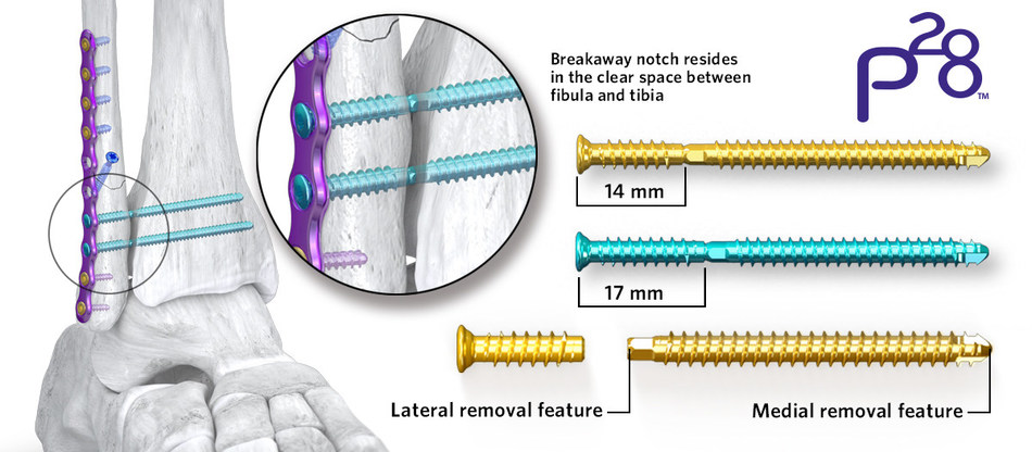 Paragon 28® adds novel syndesmotic repair solution to its robust ankle ...