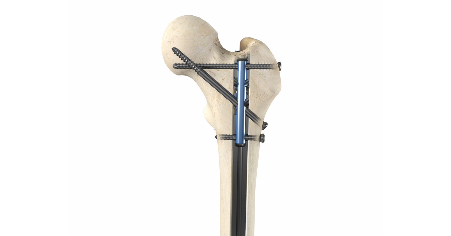 OrthoXel™ Evolving Fracture Fixation Announce FDA 510(k) Clearance for ...