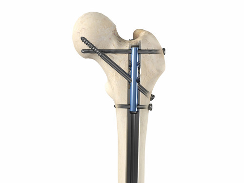OrthoXel™ Evolving Fracture Fixation Announce FDA 510(k) Clearance for ...