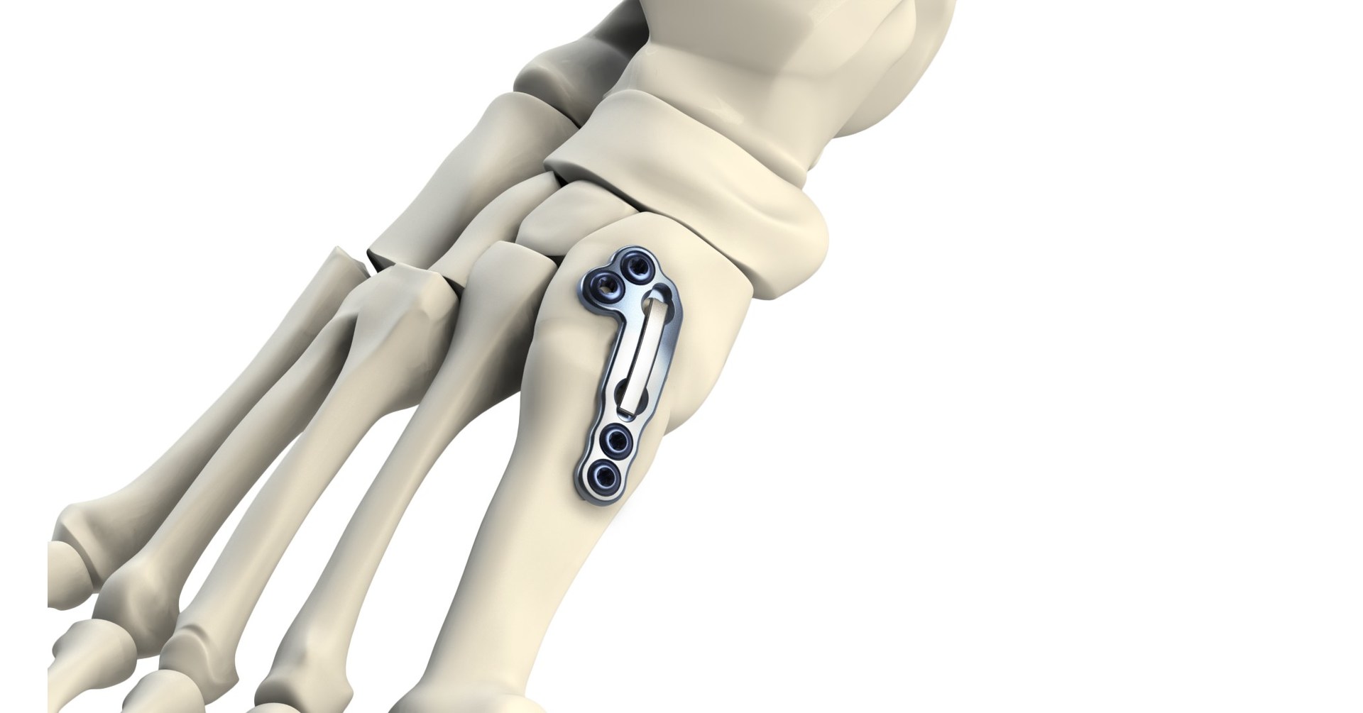 CrossRoads® Extremity Systems Announces Expansion of its Proprietary ...