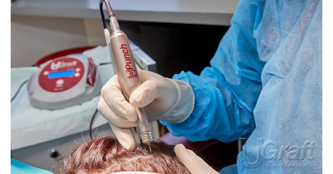 Los Angeles Dermatologic Surgeon Solves African Hair Transplantation ...