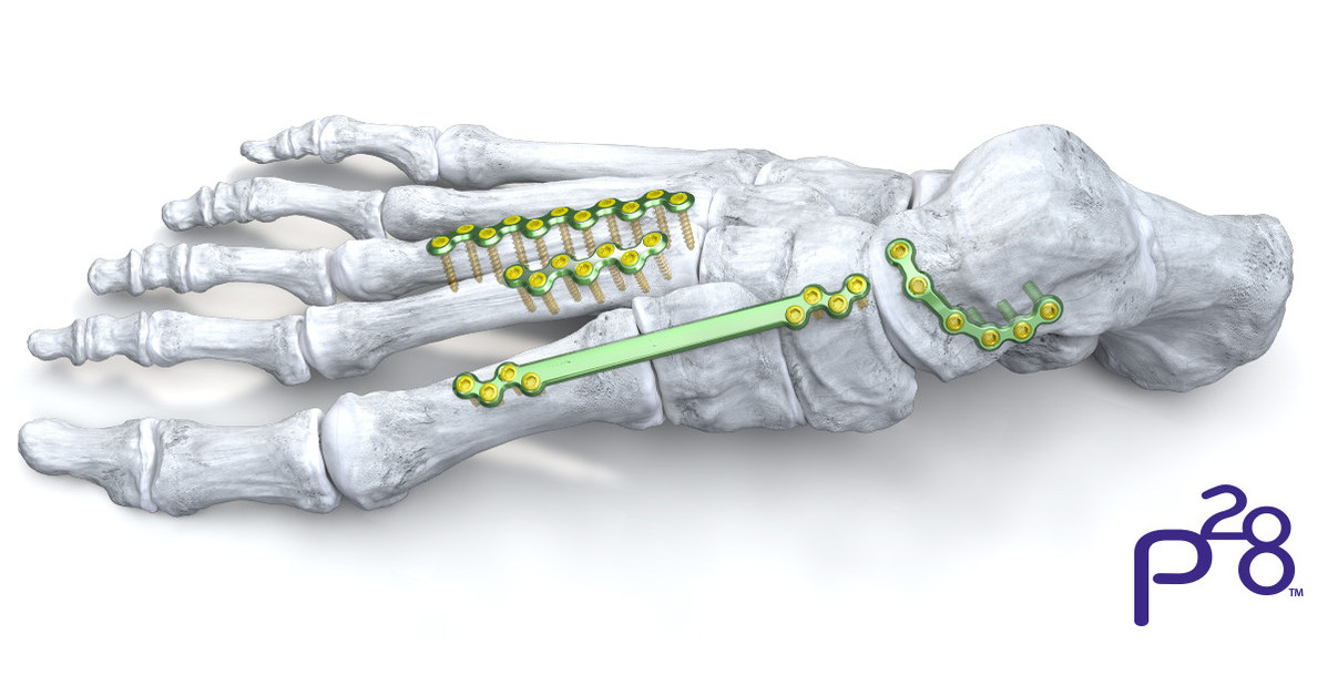 Paragon 28® releases another wave of state of the art plating options ...
