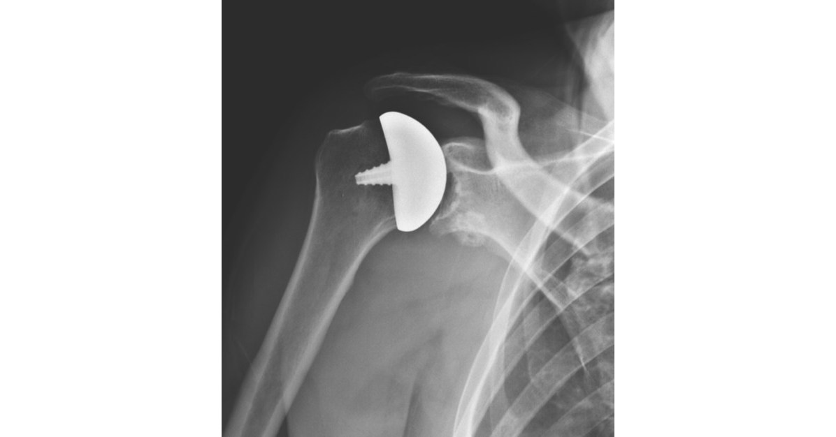 Arthrosurface Launches the Stemless OVOMotion™ Shoulder Arthroplasty System