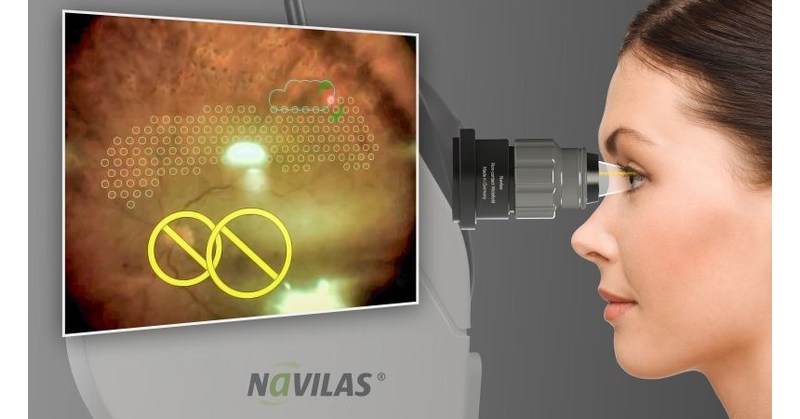 AAO 2018: Non-contact Panretinal Photocoagulation for Navilas® 577s ...