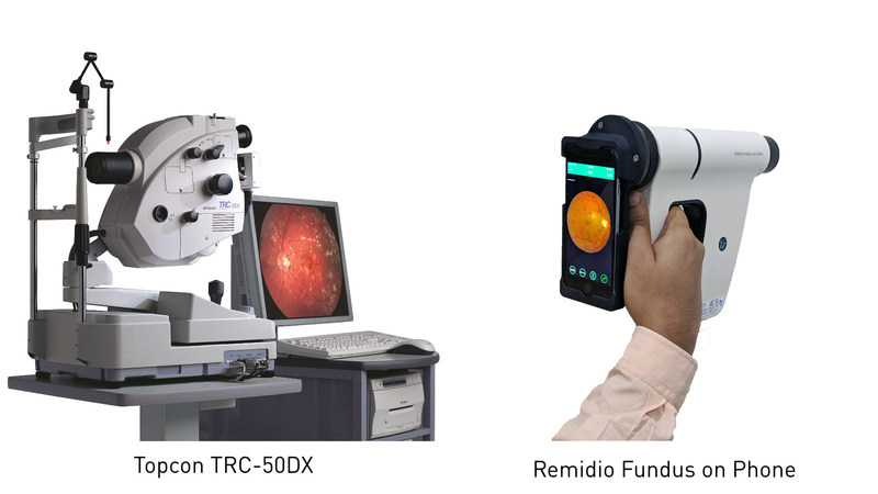 Smartphone-based Remidio Fundus-On-Phone Camera, Developed by Remidio ...