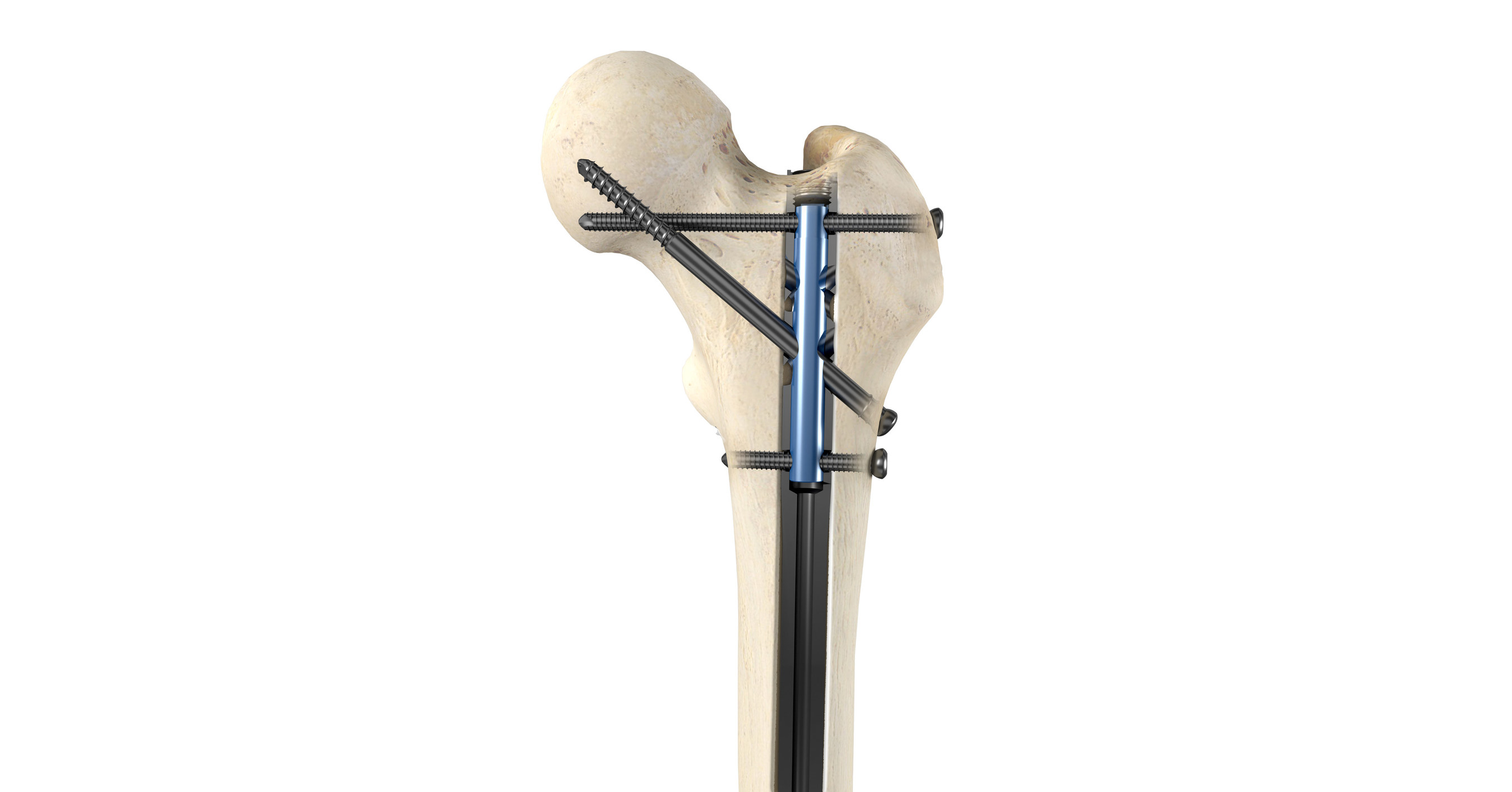 OrthoXel™ Orthopaedic Trauma Device Company Announce CE Mark Clearance ...