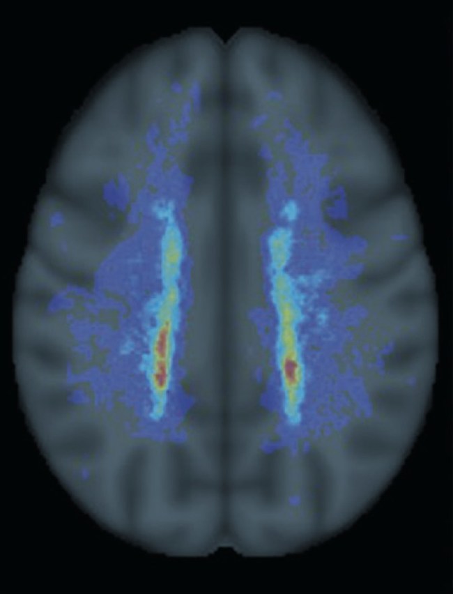 NeuroRx Research Developed Novel Brain MRI Measures of Chronic Lesion ...