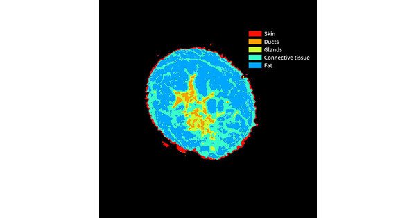 Quantitative Transmission Ultrasound Featured Throughout SPIE Medical ...