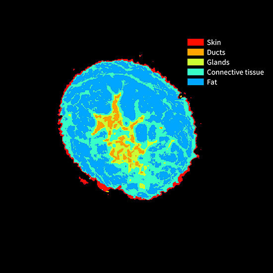 Quantitative Transmission Ultrasound Featured Throughout SPIE Medical ...