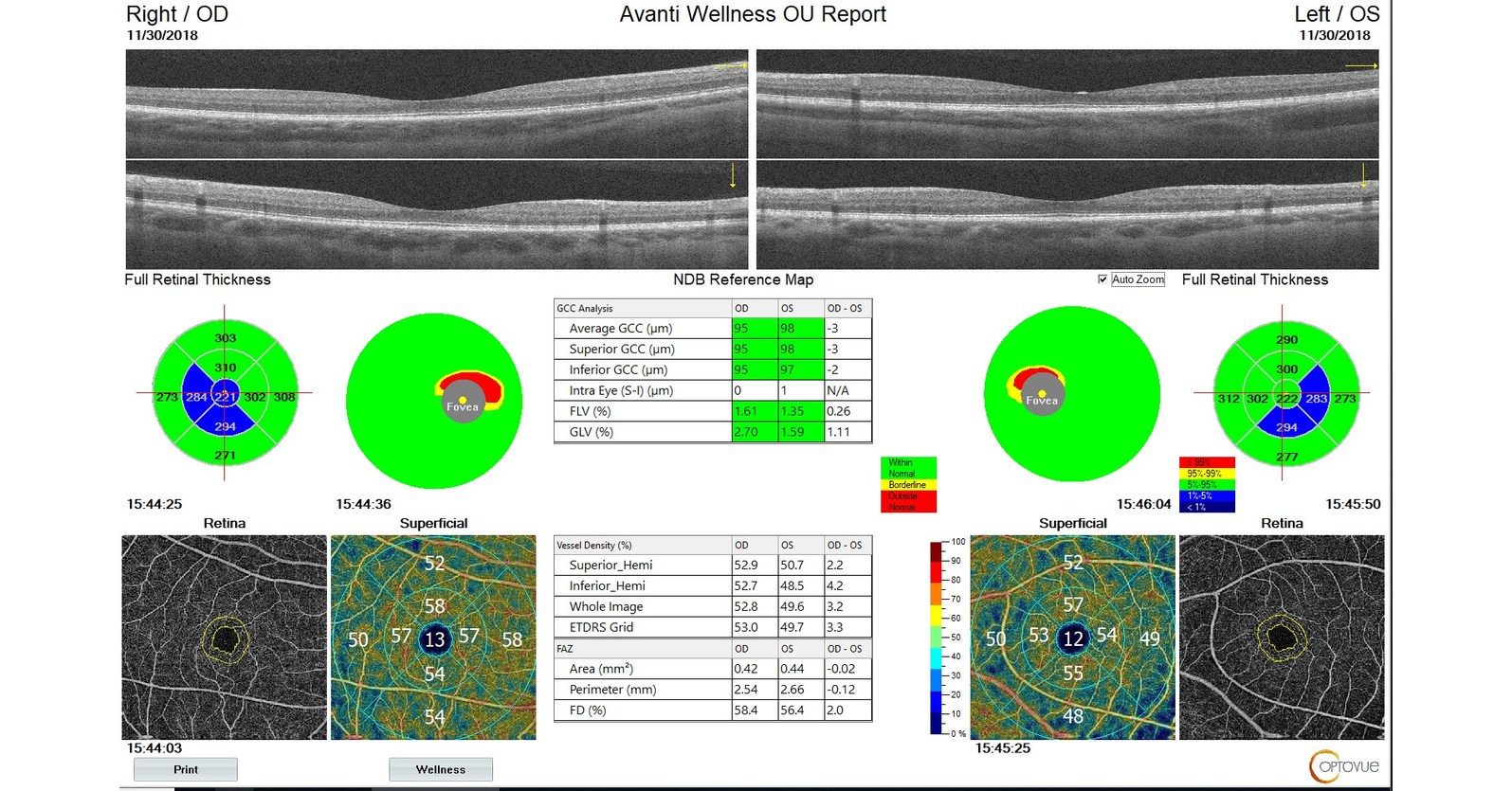 Optovue Launches New AngioWellness™ Scan at Vision Expo East