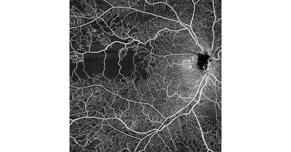 ZEISS Launches First Dual-Speed Swept-Source OCT/OCTA at the ...