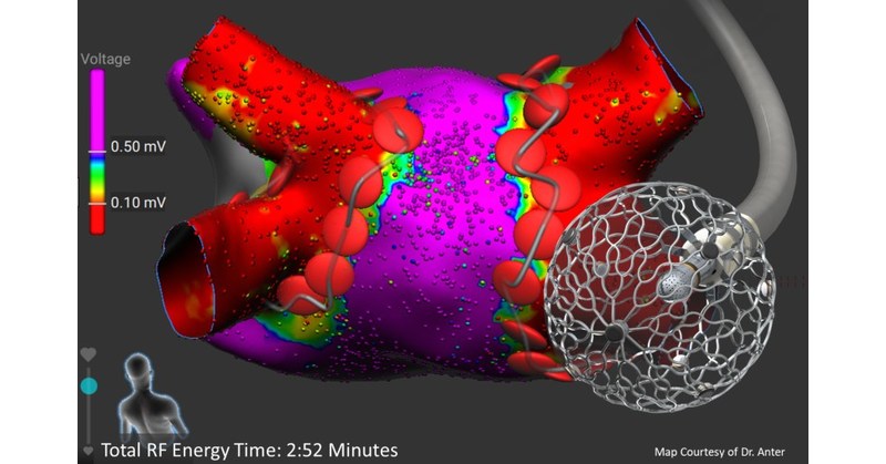 Affera's Technology For Cardiac Arrhythmia Treatment To Be Highlighted ...